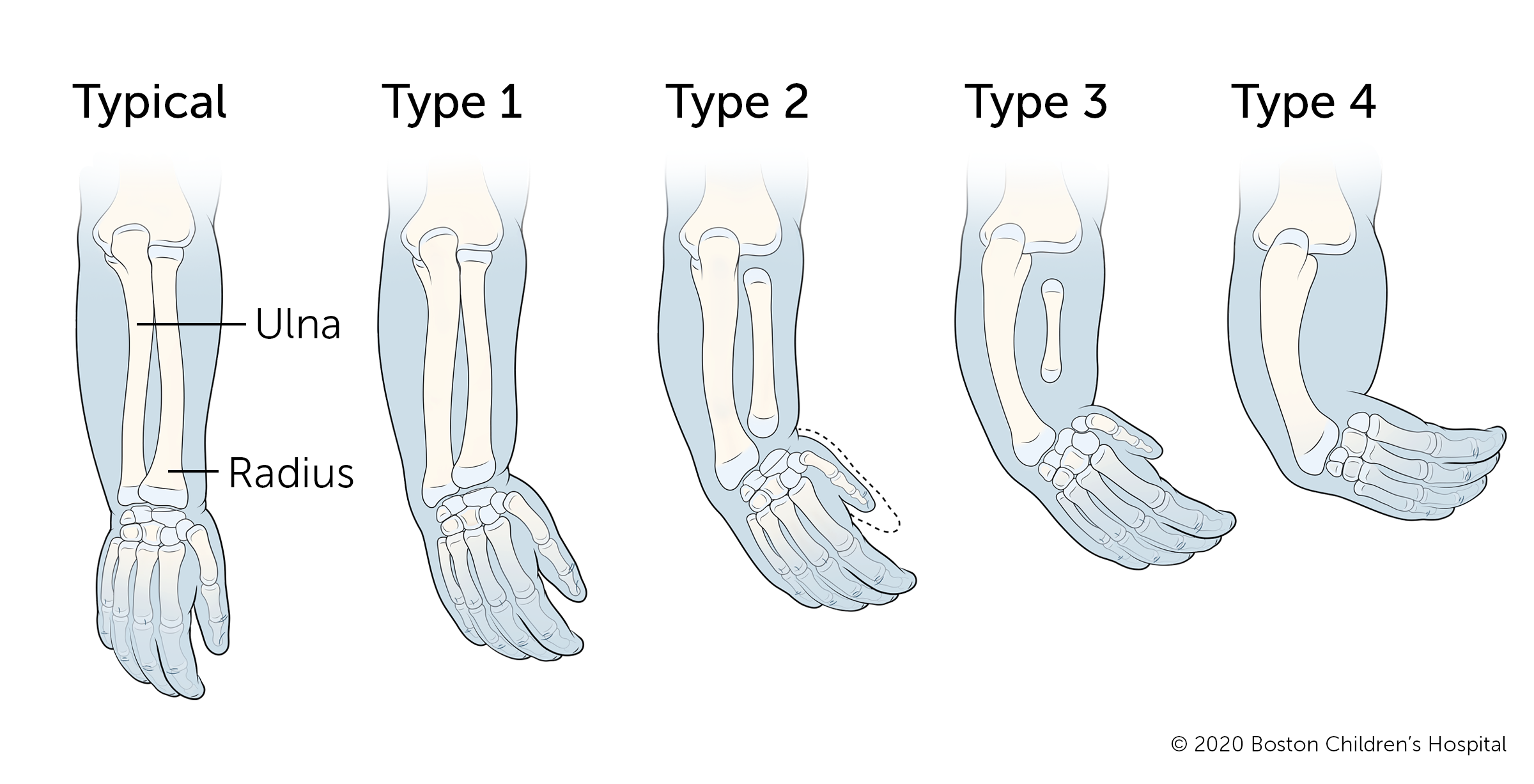 Radial Longitudinal Deficiency | Boston Children's Hospital - ob欧宝体育app下载