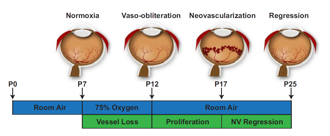 Retinopathy of Prematurity | Boston Children's Hospital - ob欧宝体育app下载